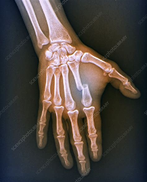Broken Metacarpal X Ray Broken Metacarpal X Ray
