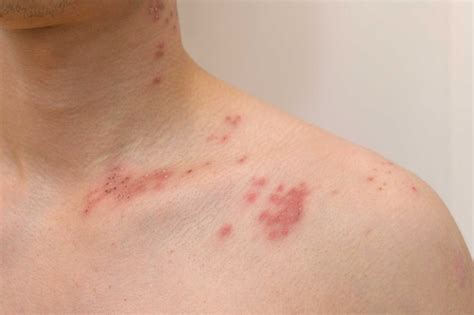 What Are The First Signs Of Shingles And How Can Vaccination Help