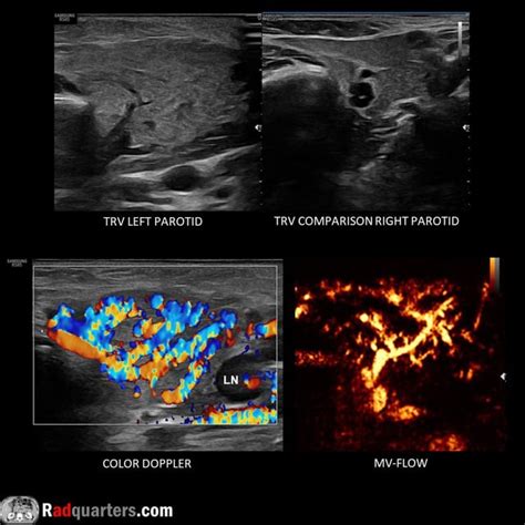 Acute Parotitis On Ultrasound Rradiology