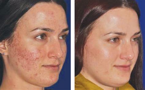 Microneedling Yorba Linda Dermatology