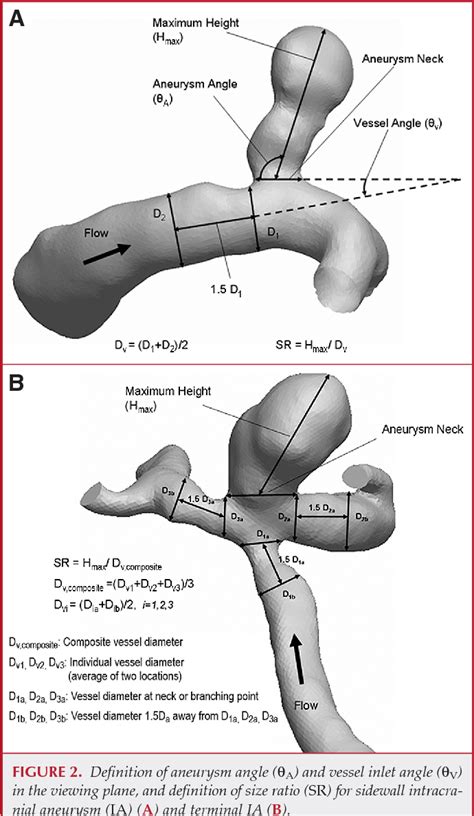 Figure 1 From Morphology Parameters For Intracranial Aneurysm Rupture Risk Assessment Semantic