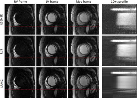 Low‐rank Motion Correction For Accelerated Free‐breathing First‐pass Myocardial Perfusion