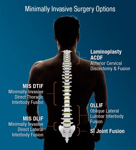 Types Of Spine Surgery In Iran Back Surgery Recovery Irantreatments