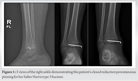 Spontaneous Resolution Of Pediatric Varus Ankle Deformity A Case