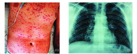 Skin Examination Polymorphic Pruritic Rash With Macular Vesicles Download Scientific Diagram