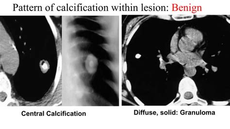 Approach To Imaging Of Solitary Pulmonary Nodule Pptx