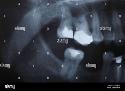 Detail X Ray Image Scan Of Humans Teeth Stock Photo Alamy