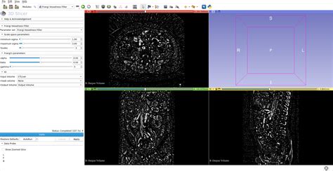 3d slicer s liver segmentation a look at the new features
