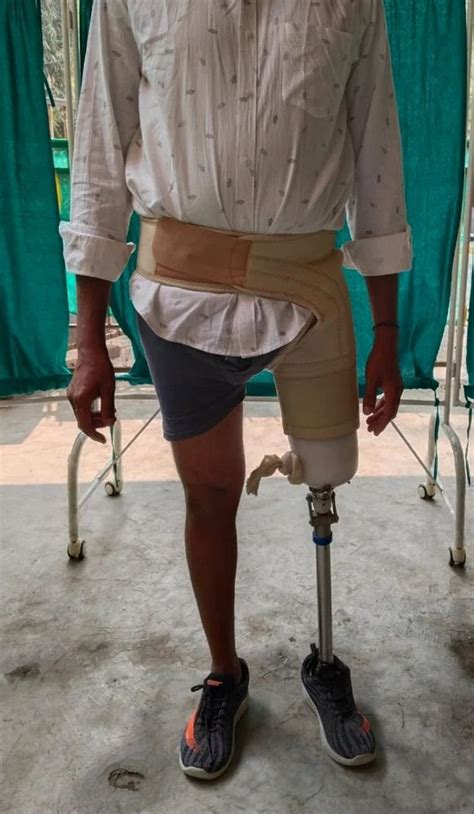 Lower Limb Above Knee Prosthesis Passive Prosthetic At ₹ 55000piece