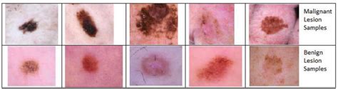figure 2 from machine learning based melanoma skin cancer