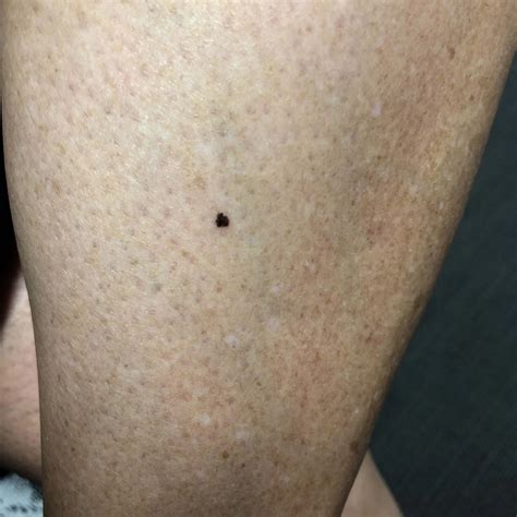 Early Stage Melanoma Pictures