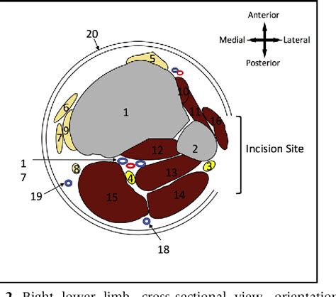 Figure From Surgical Management Of Proximal Tibiofibular Joint Instability Using An Adjustable