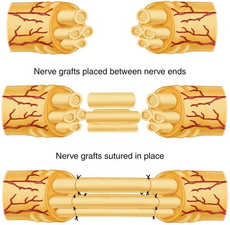 Peripheral Nerve Injuries Clinical Tree