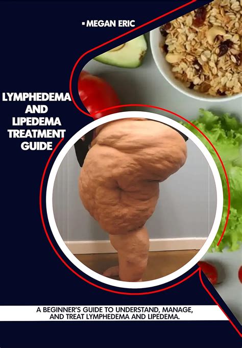 Lymphedema And Lipedema Treatment Guide A Beginners Guide To