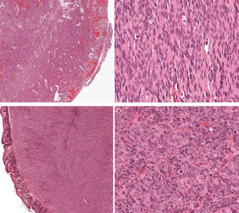 Pathology Of High Risk Gist Spindle And Epithelioid Types Download