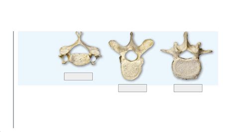 Schwarzlose Differences In Vertebral Diagram Quizlet