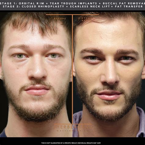 Botox Gone Wrong 7 Signs Of Bad Botox And How To Avoid Or Fix Botched Injections Sherber Rad