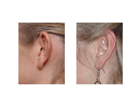 Otoplasty Surgery Ear Pinning Dr Barry Eppley Indianapolis Explore Plastic Surgery