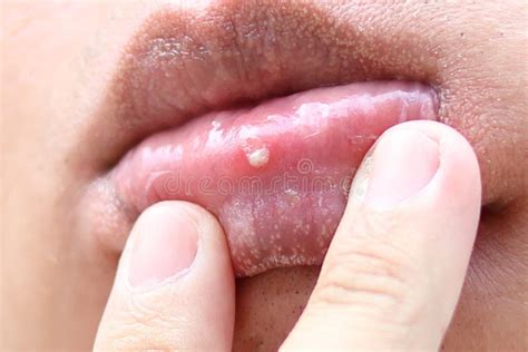 Closeup Showing A Canker Sores Aphthous Ulcer Inside Male Lip Stock