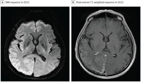 Jama Neurology Auf Linkedin Diffuse Cortical Injury And Basal Ganglia