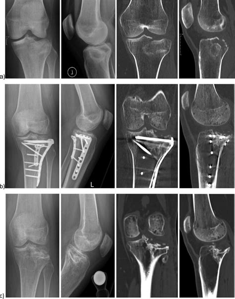 A Initial Posttraumatic X Rays And CT B 9 Months After ORIF C 4 Download Scientific