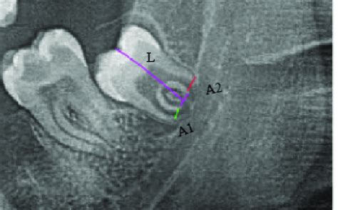 Variables Shown On The Third Molar Download Scientific Diagram