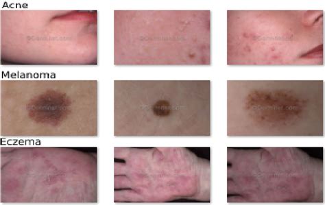 Figure 1 From Skin Disease Classification Using Convolutional Neural Network Semantic Scholar