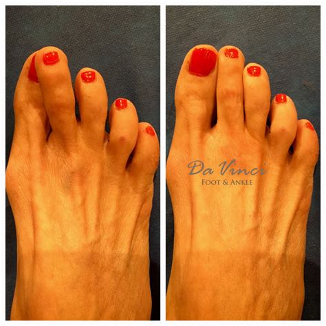 Hammer Toes Surgery