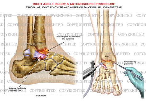 Talofibular Ligament Tear Joint Synovitis And Synovectomy — Medical Art