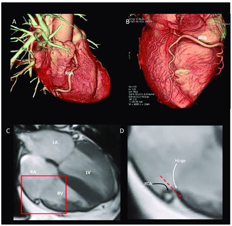 Ct Scan Volume Rendering Showing The Undulating Course Of Right