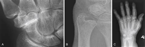 Wrist Arthrodesis And Arthroplasty Clinical Tree