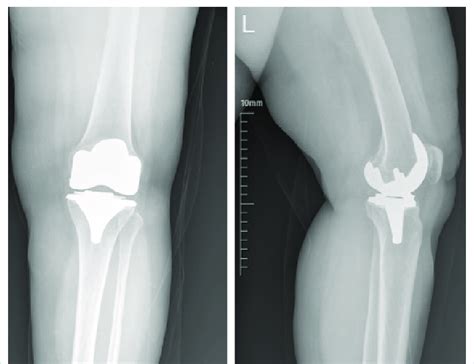Prosthesis Control With Anteroposterior And Lateral Knee Radiographs Download Scientific Diagram