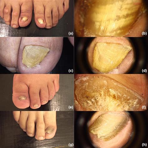 Total Dystrophic Onychomycosis