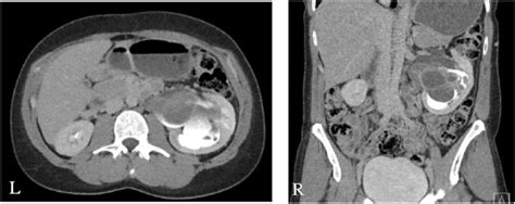 Preoperative Ct Scan Of The Abdomen And Pelvis With Intravenous Download Scientific Diagram