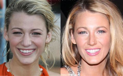 Blake Lively Two Minor Plastic Surgery Procedures