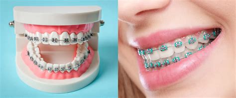 Todo Lo Que Necesitas Saber Sobre Los Brackets Guía Completa