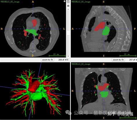 Vessel2012——肺血管分割 知乎