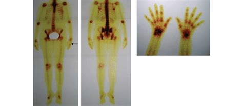Pattern Of Involvement In Rheumatoid Arthritis Download Scientific Diagram