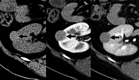 Angiomyolipoma Ultrasound