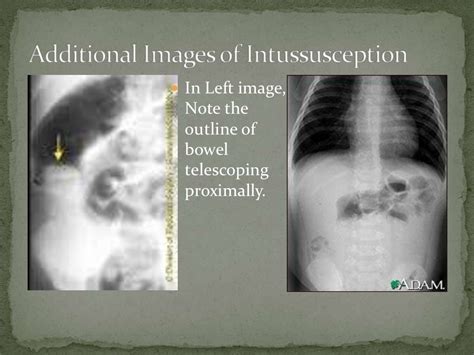 Intussusception Power Point