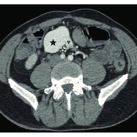 Pre Operative Computed Tomography ¼ Superior Mesenteric Vein 5 ¼ Download Scientific