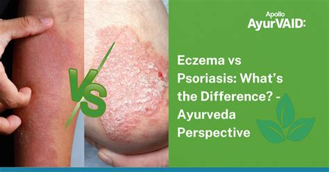Eczema Vs Psoriasis Whats The Difference