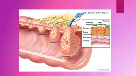 Polipos Poliposis Adenocarcinoma Y Carcinoide Intestinal Ppt