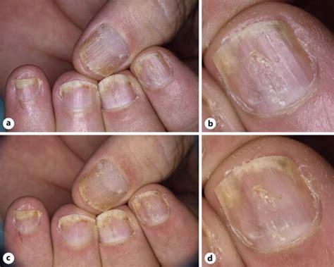 A B Photographs Of A Psoriasis Patient Captured Using A Ring Flash Download Scientific Diagram