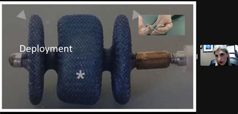 Global Embolization Symposium And Technologies Gest On Linkedin Interventionalradiology Ir