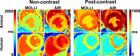 Non Contrast And Post Contrast Molli And Air Cardiac T1 Maps For A
