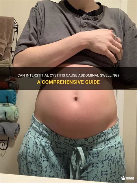 Can Interstitial Cystitis Cause Abdominal Swelling A Comprehensive