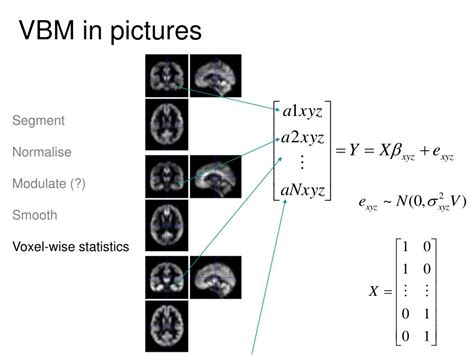Ppt Voxel Based Morphometry With Unified Segmentation Powerpoint