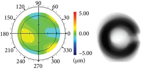 Slit Lamp Examination Of The Ohb Before A And After Bleb Excision C Download Scientific