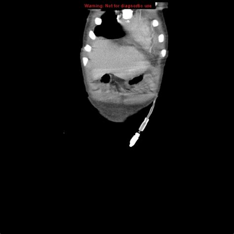 Appendicitis With Phlegmon Radiopaedia 9358 10046 B Nc Commons